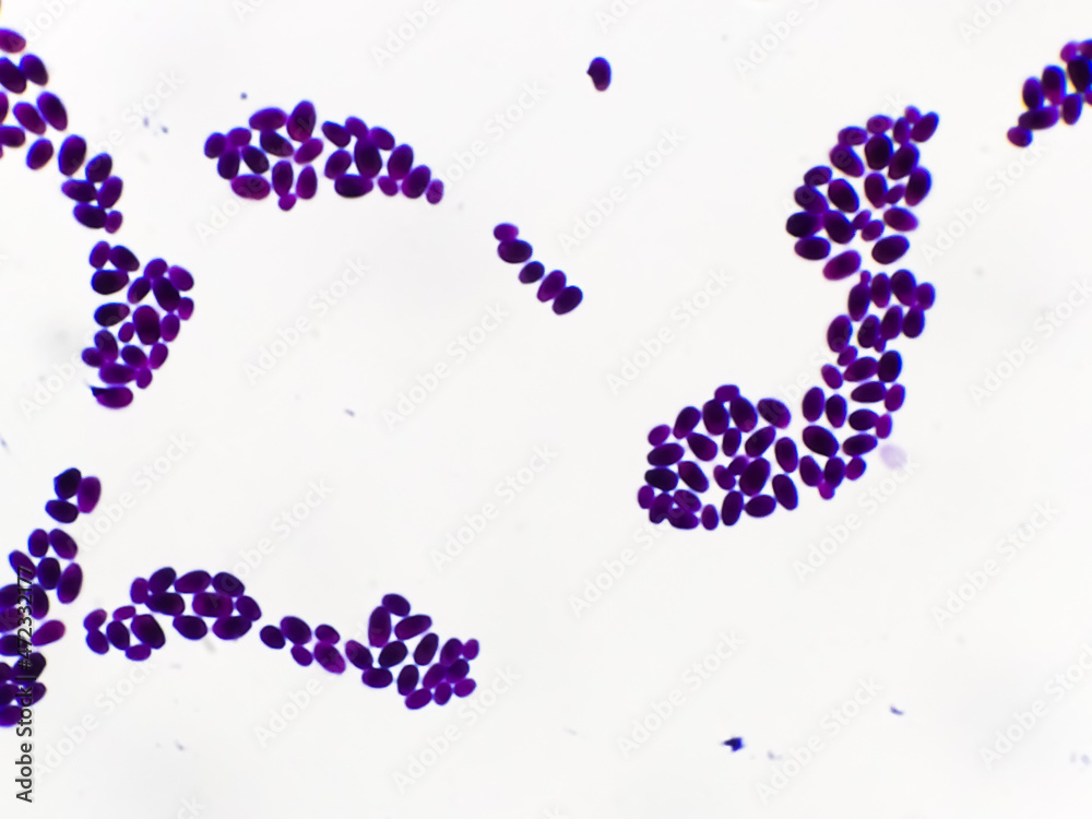 Culture colonies gram stained Microscopic 100x show Candida spp, fungi ...