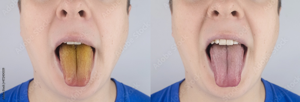 Before and after. Man has a yellow tongue. Painful yellow coating on ...