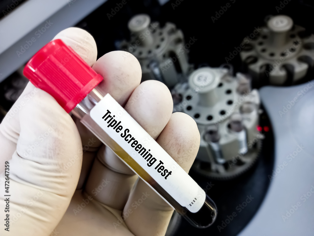 Scientist holding blood sample for Triple screening test(AFP, beta HCG ...