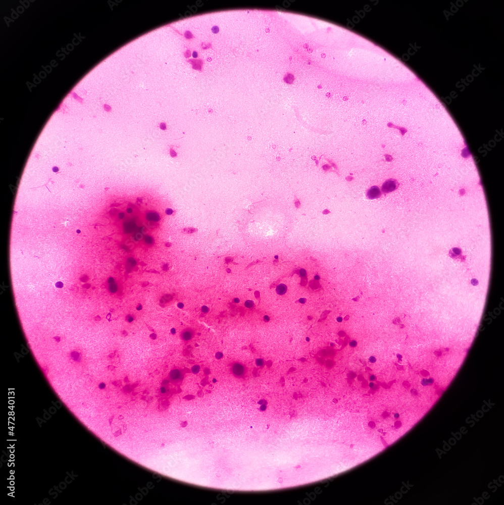 Inguinal lymph node, Malignant small round cell tumor, metastatic ...
