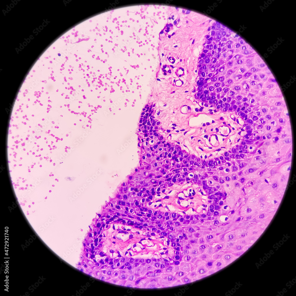 Stock-Foto „Buccal mucosa, Squamous hyperplasia, show hyperplastic ...