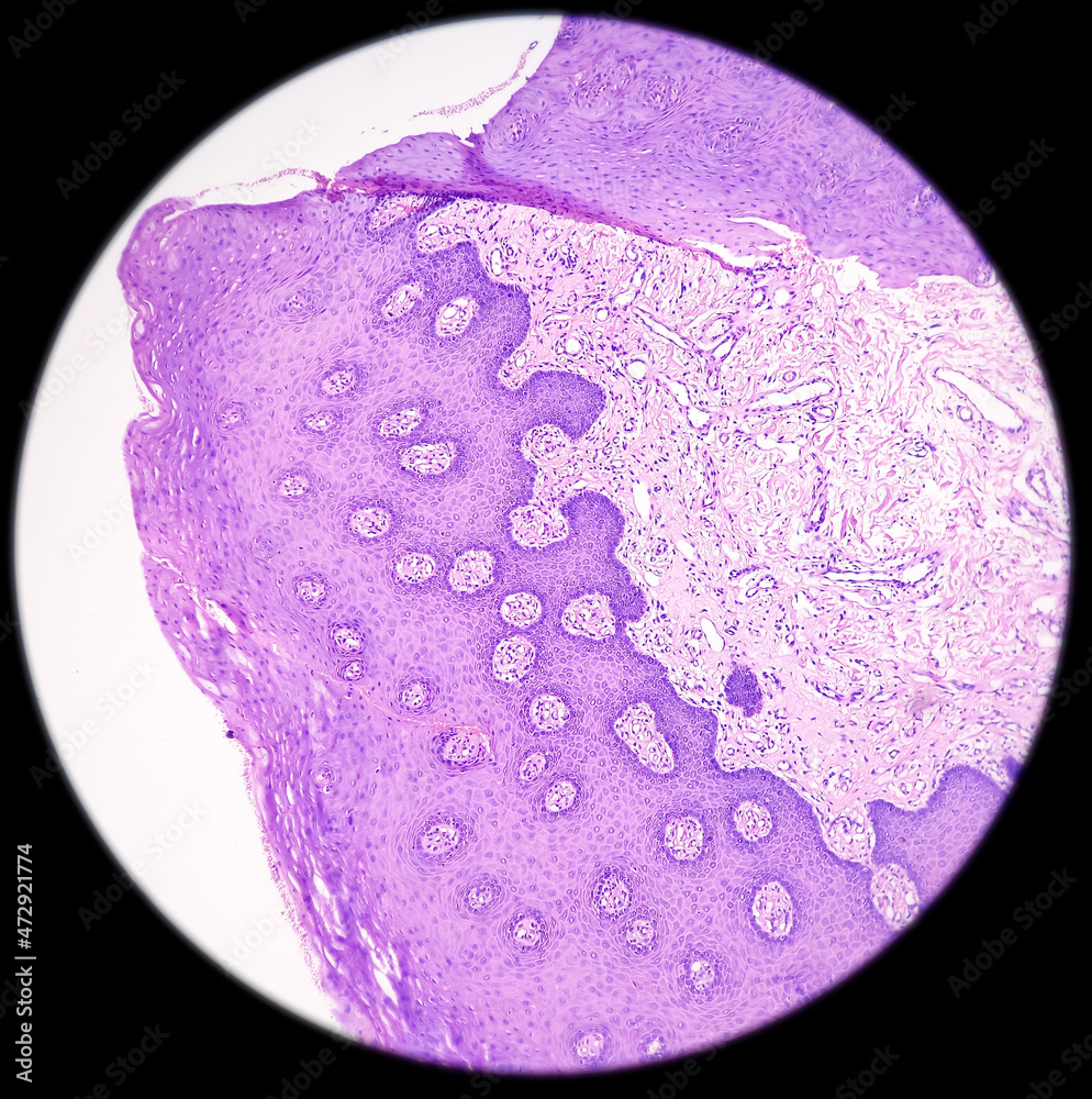 Foto de Stock Buccal mucosa, Squamous hyperplasia, show hyperplastic ...