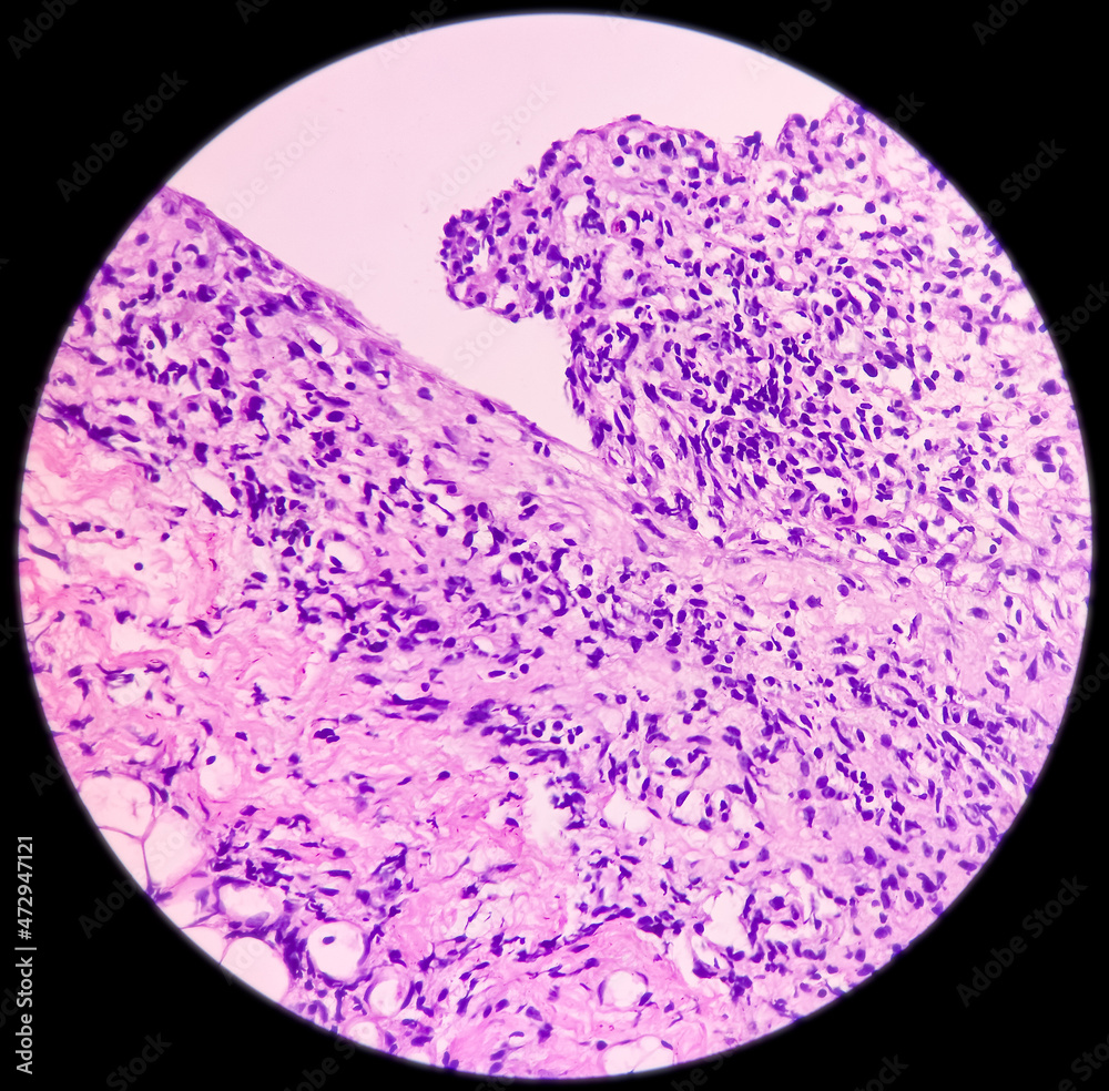 Foto de Stock Pleural cancer: Photomicrograph of skeletal muscle ...