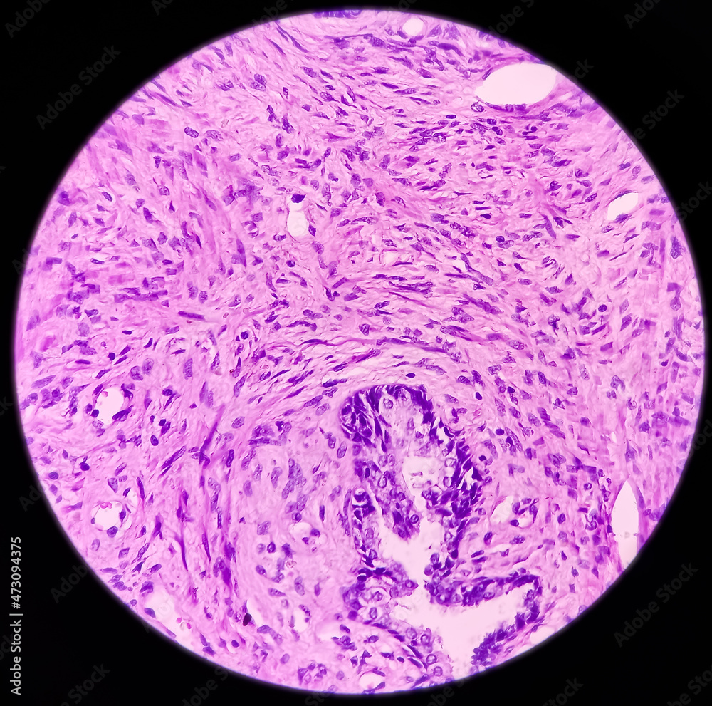 Benign prostatic hyperplasia. Micrograph show proliferation of fibro ...