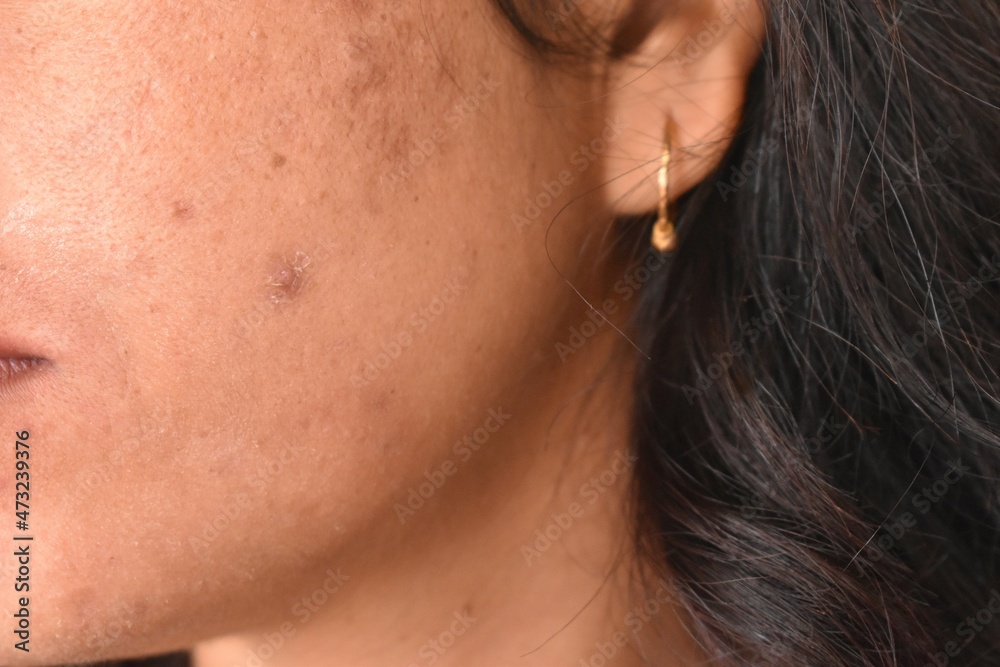 Pimples, Dark spots, freckles, dry skin on face middle age woman ...