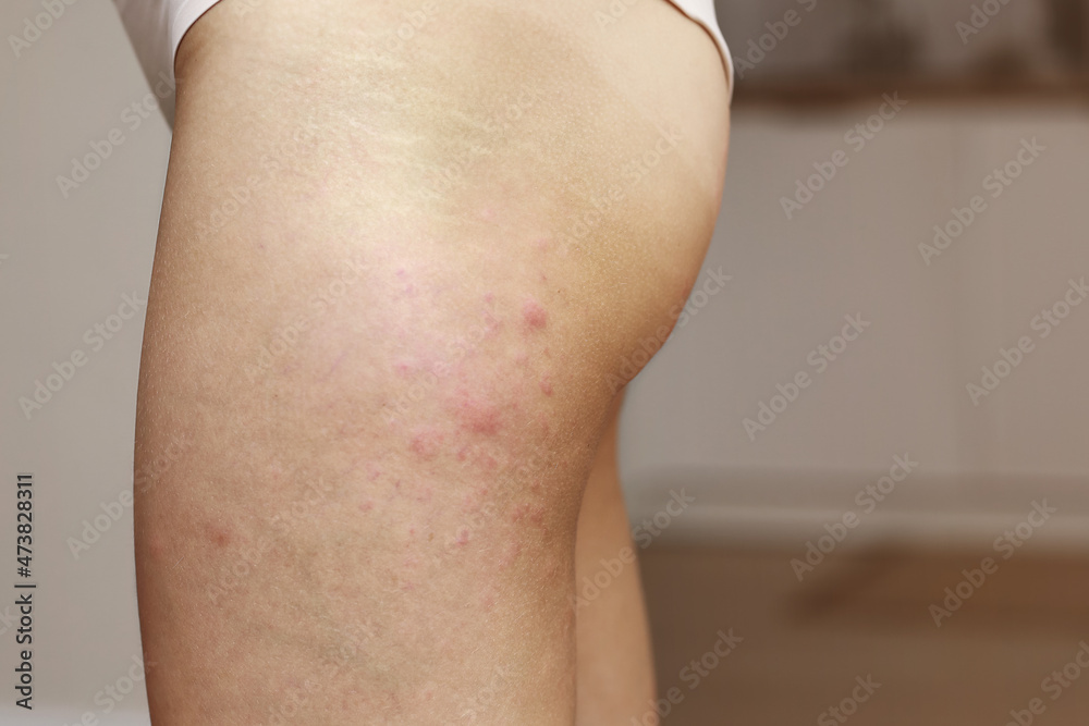skin allergies, hips skin women. Closeup of red pustules on a hips, an ...