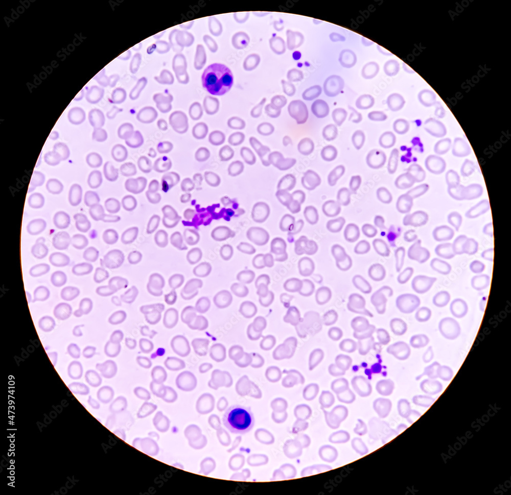 Essential thrombocytosis blood smear showing abnormal high volume of ...