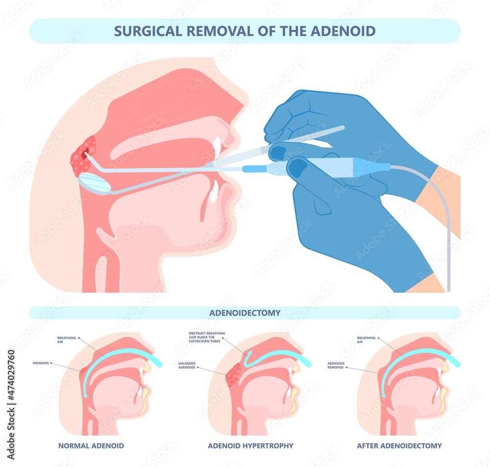 Adenoidectomy. Throat back voice box larynx vocal cord pain airway ...