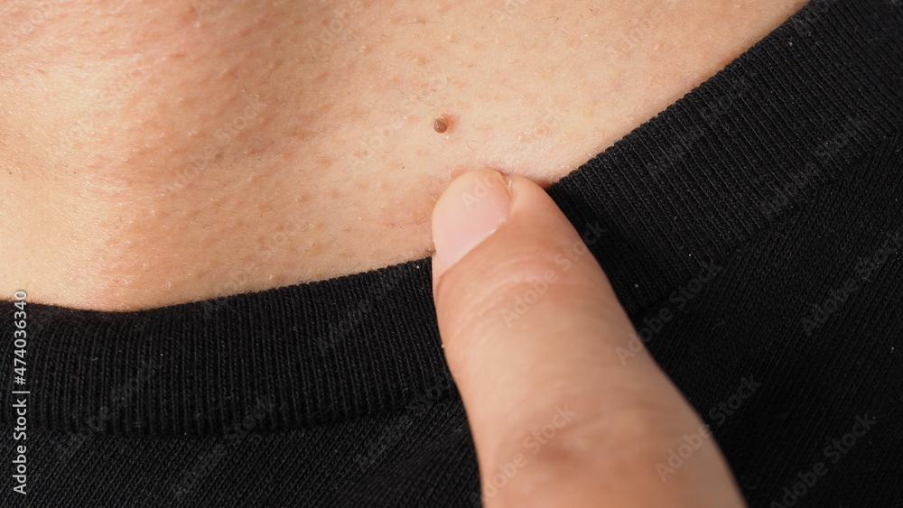 Stock-Foto „Wart on face. Macro shot of wart near eye. Papilloma on ...