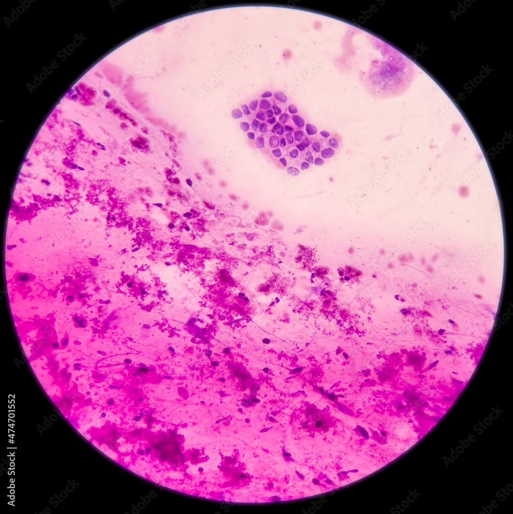 High grade squamous intraepithelial lesion(HSIL). Photomicrograph of ...
