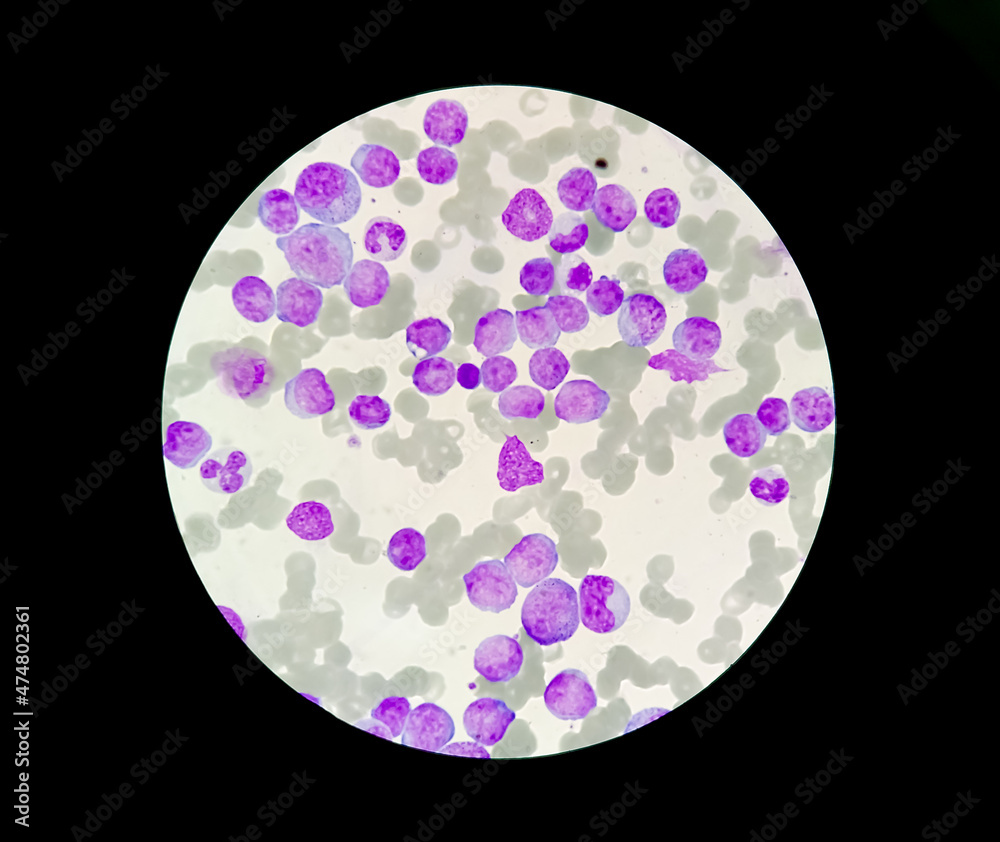 Photomicrograph of Acute Myeloblastic Leukemia (AML), a cancer of white ...