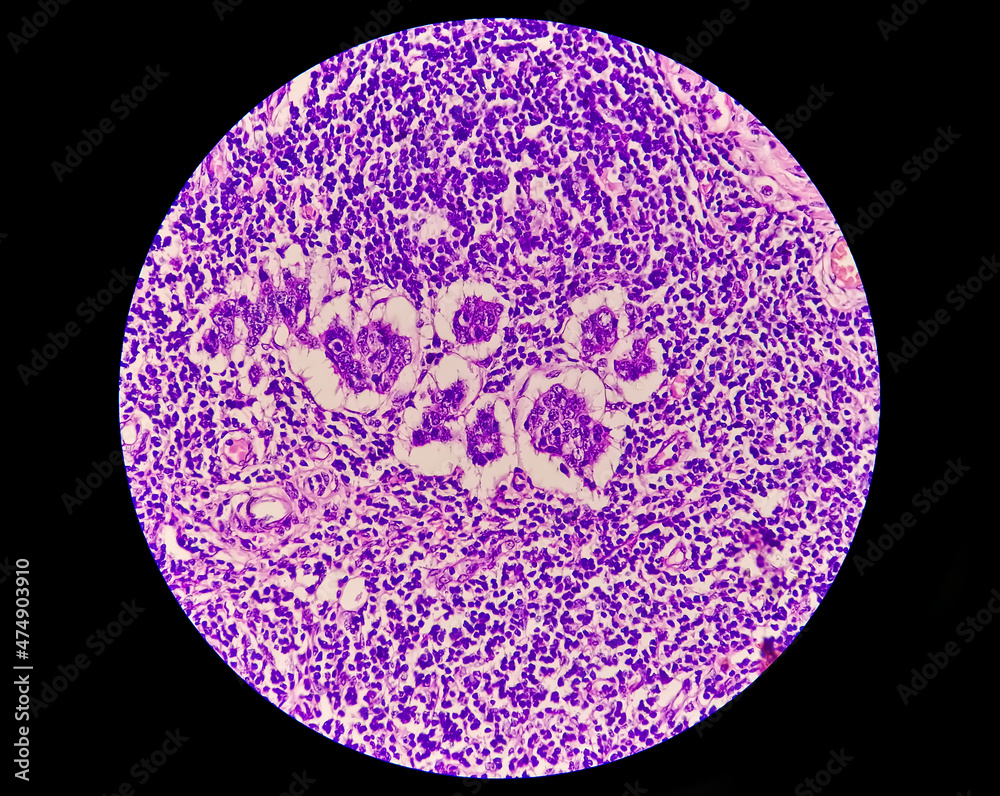 Photomicrograph of Invasive ductal carcinoma (IDC) grade-II, most ...