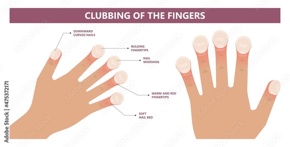Nail clubbing. Symptoms tetralogy of Fallot bone swelling warning sign ...
