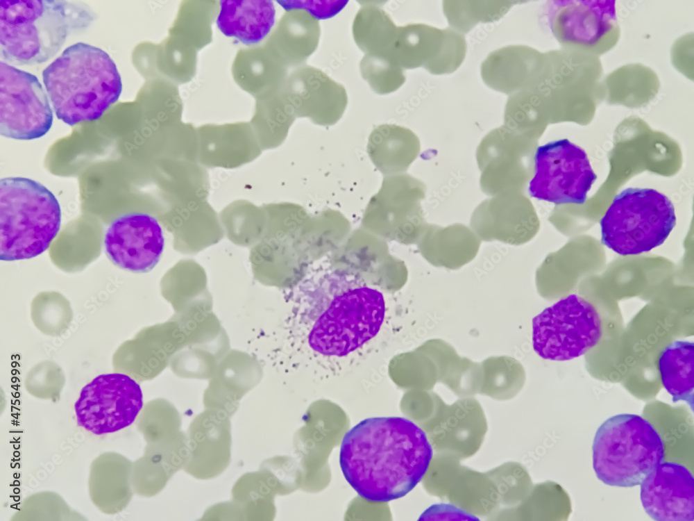 Chronic myeloid leukemia cells or CML, analyze by microscope, original ...