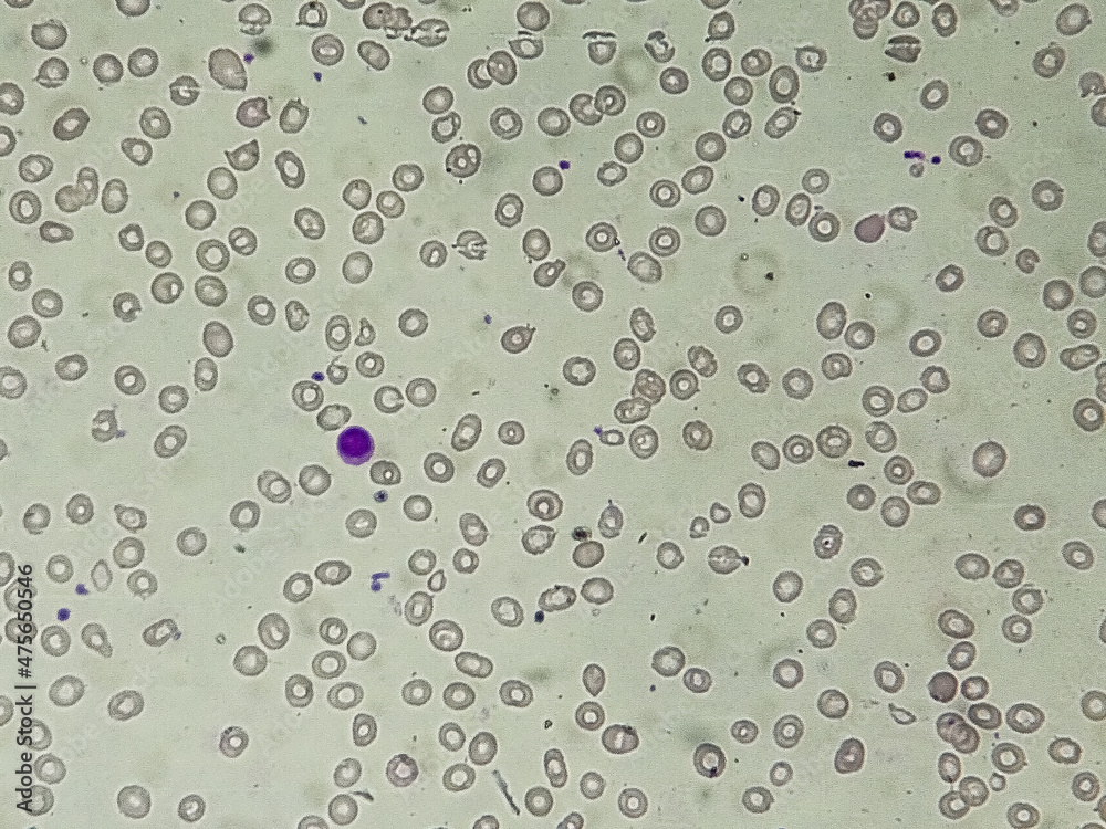 Macrocytic anemia with features of hemolysis and nucleated RBC analyzed ...
