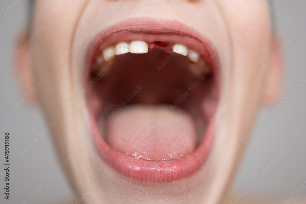 Close-up macro baby teeth. Loss of milk teeth in a child. Isolated ...