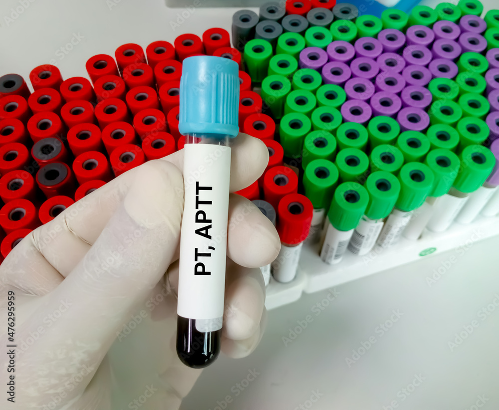 Blood sample for PT, APTT test. coagulation factor testing, diagnosis ...