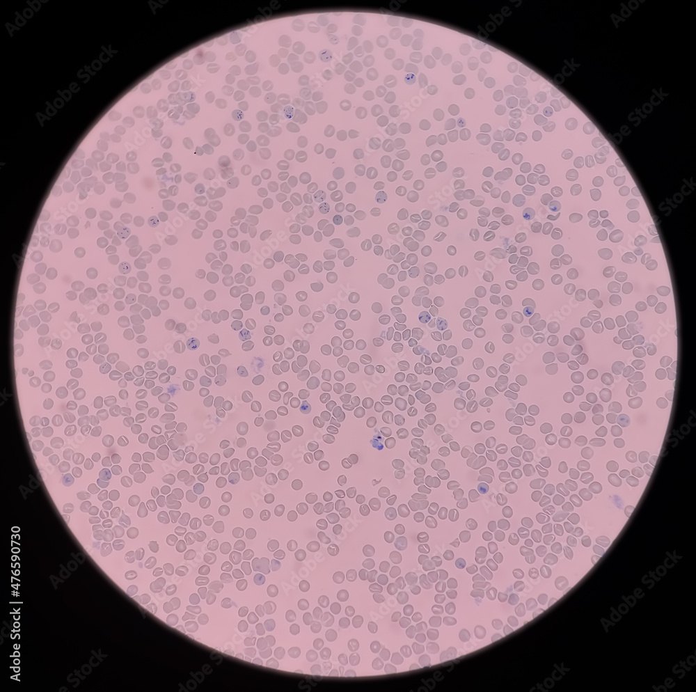 Reticulocyte count under microscope, 100x. methylene blue staining ...