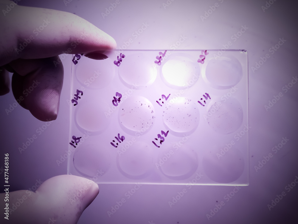 RPR, VDRL, Syphilis test glass slide agglutination method. showing ...