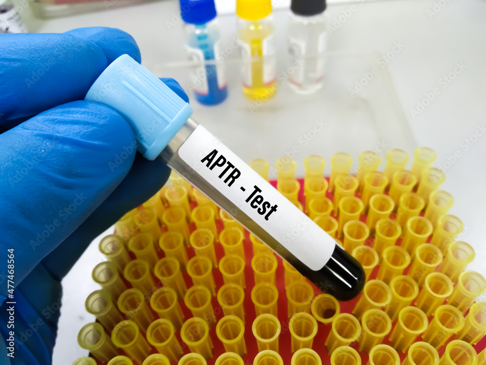 Blood sample tube for Activated Partial Thromboplastin Ratio (APTR ...