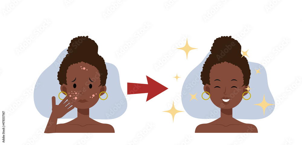 Pimple Cartoon Face
