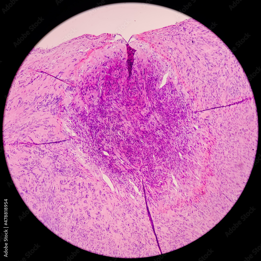 Fibroid uterus leiomyoma, myoma, also known as fibroids, benign tumor ...