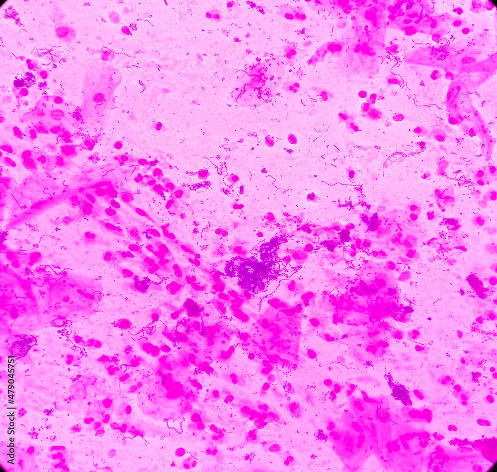 Sputum gram stain: Microscopic view show plenty pus cells and few ...