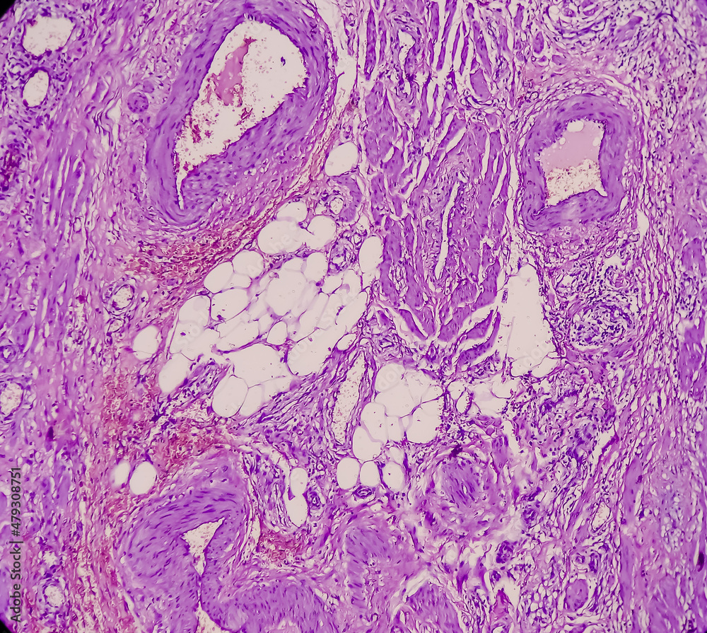 Tissue from endometrial polyp: Ovarian polyp, show myomatous polyp ...