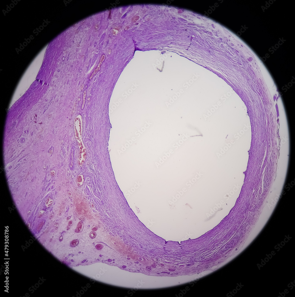 Tissue from endometrial polyp: Ovarian polyp, show myomatous polyp ...