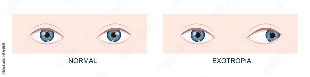 Exotropia. Horizontal strabismus before and after surgery. Eye ...