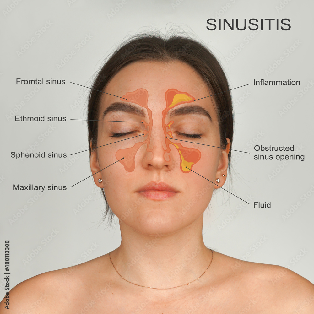 Sinusitis. Healthy and inflammation nasal sinus. Medical diagram. Stock ...