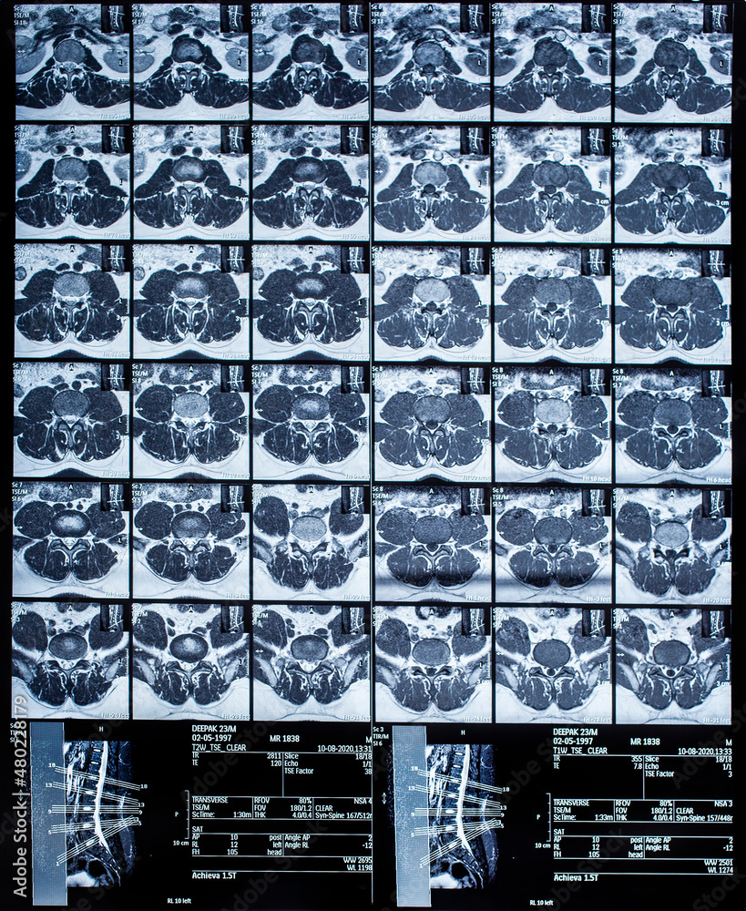 Fotografie magnetic resonance imaging or mri scan report of spinal cord ...