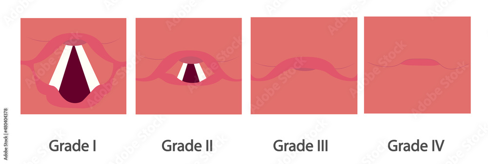 Cormack-Lehane system to assess the airway dificulty in intubation ...