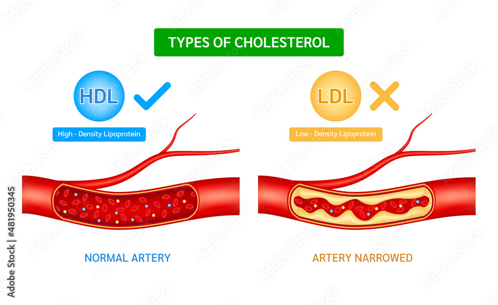 Types of cholesterol comparison with HDL High density lipoprotein and ...