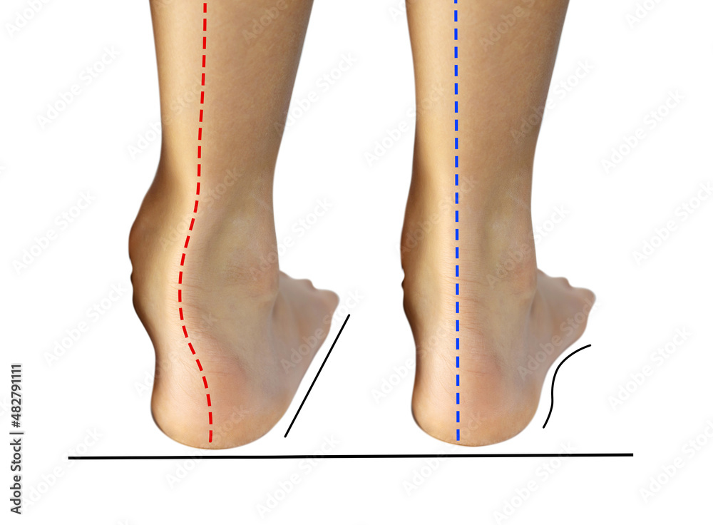 Boy's feet with flat feet or fallen arch, ankle lean inward causing leg ...