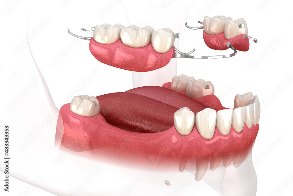 Removable partial denture, mandibular prosthesis. Medically accurate 3D ...