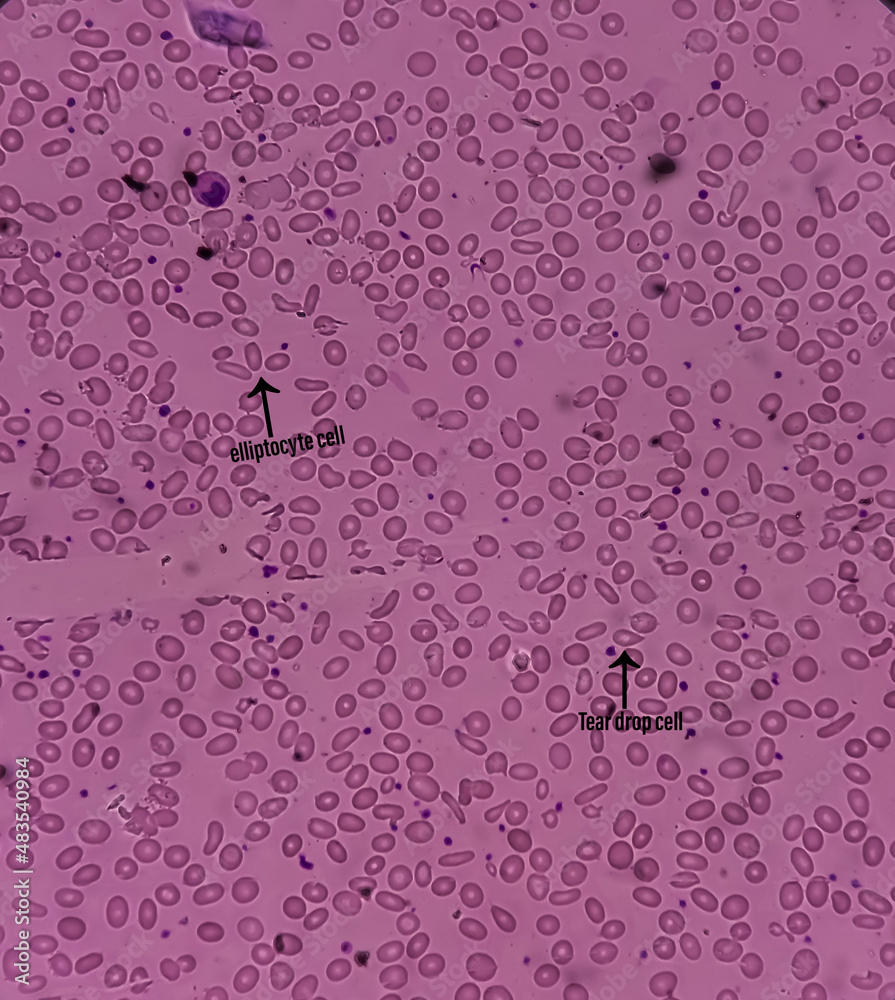 Hereditary elliptocytosis, hereditary disorder of RBCs, Ovalocytes or ...