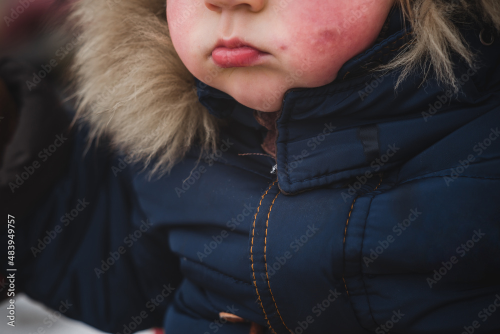 two years old boy child with red cheeks- enterovirus infection ...