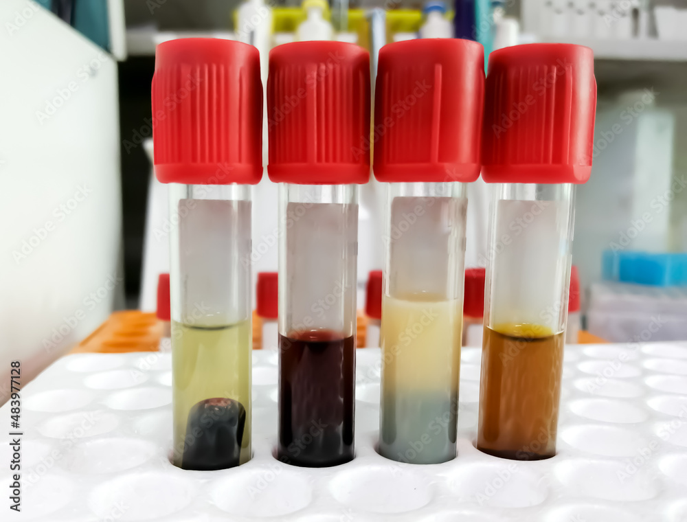 Common types of blood serum sample errors. Different types of sample ...