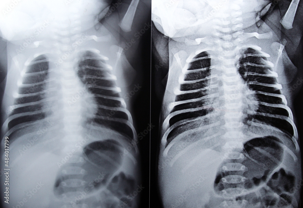 Selective focus of a plain chest x ray for a newborn infant in ...