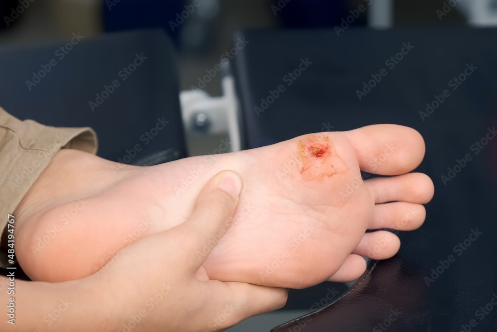 Wound of removed wart after laser removal on patient boy's foot ...