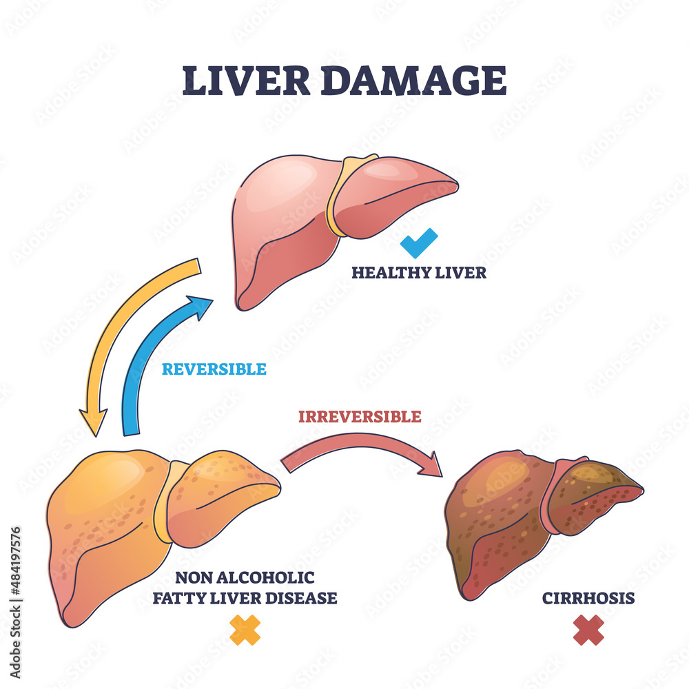 Liver damage stages with reversible and irreversible disease outline ...