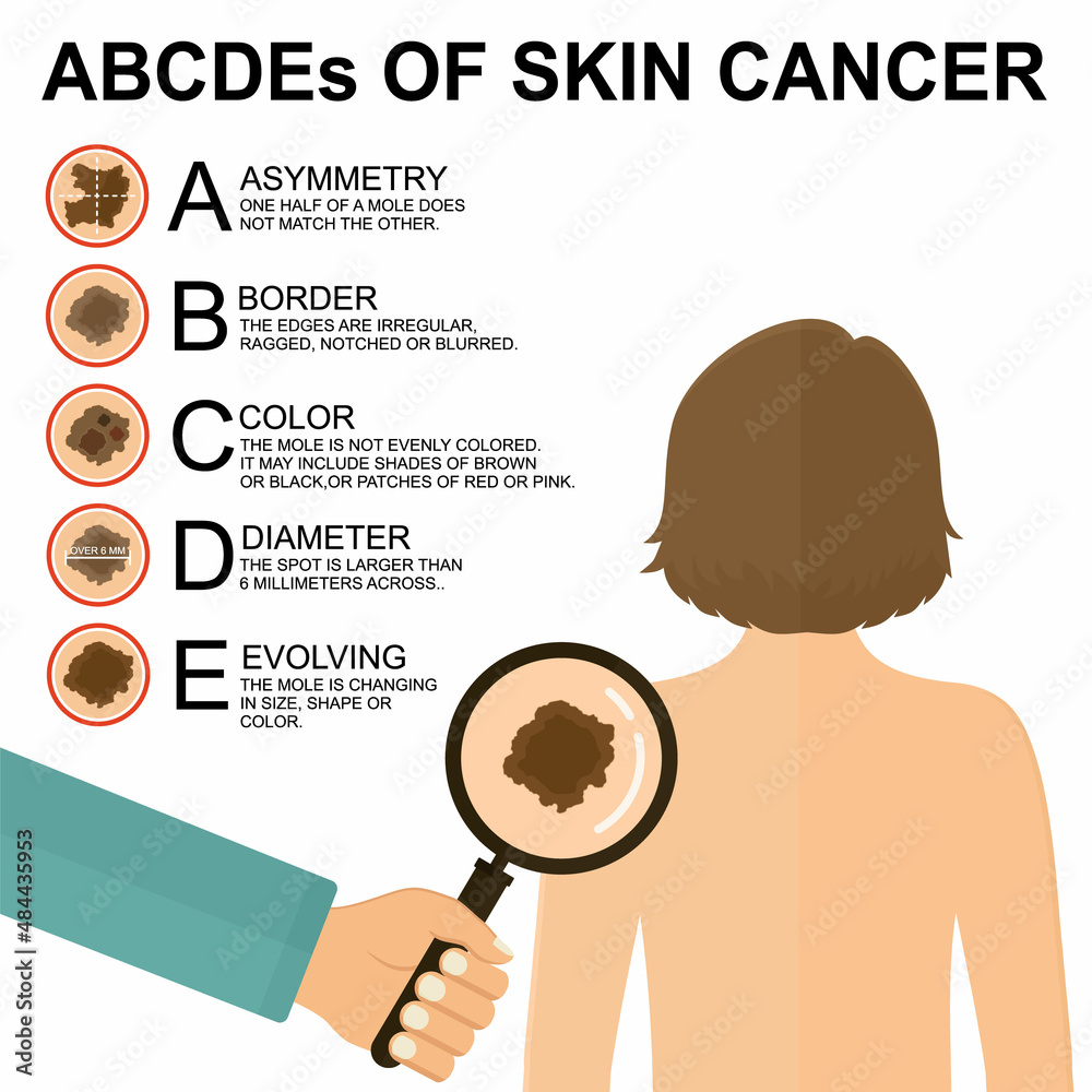 Diagnosis of skin cancer. Melanoma warning signs. Dermatological ...