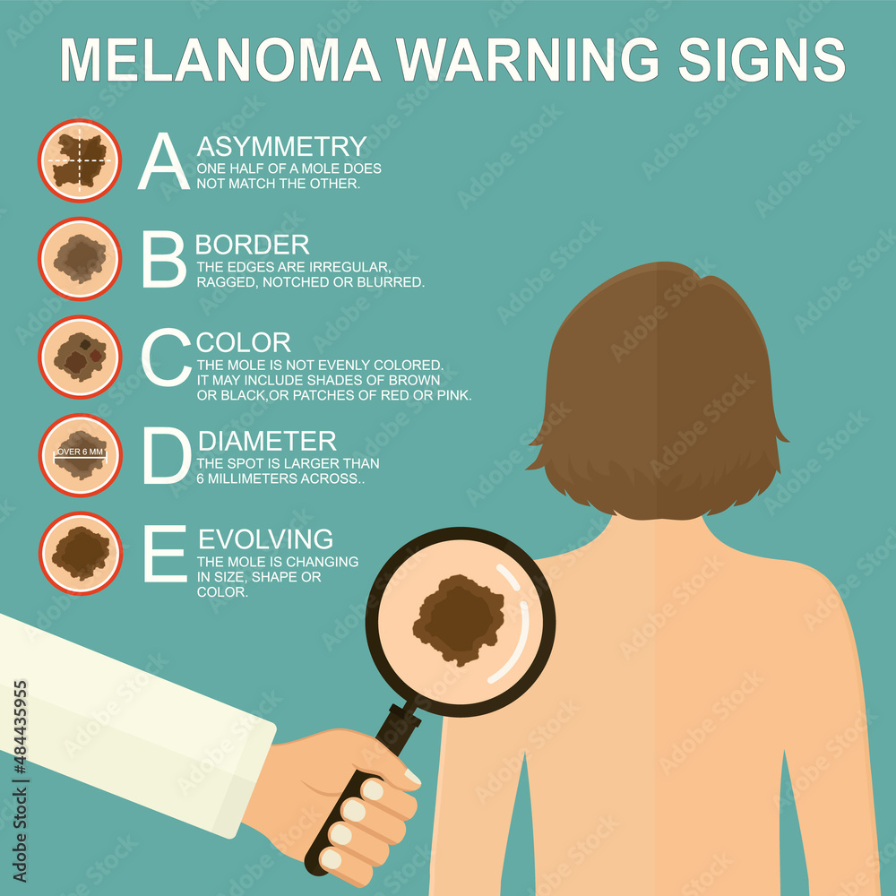Diagnosis of skin cancer. Melanoma warning signs. Dermatological ...