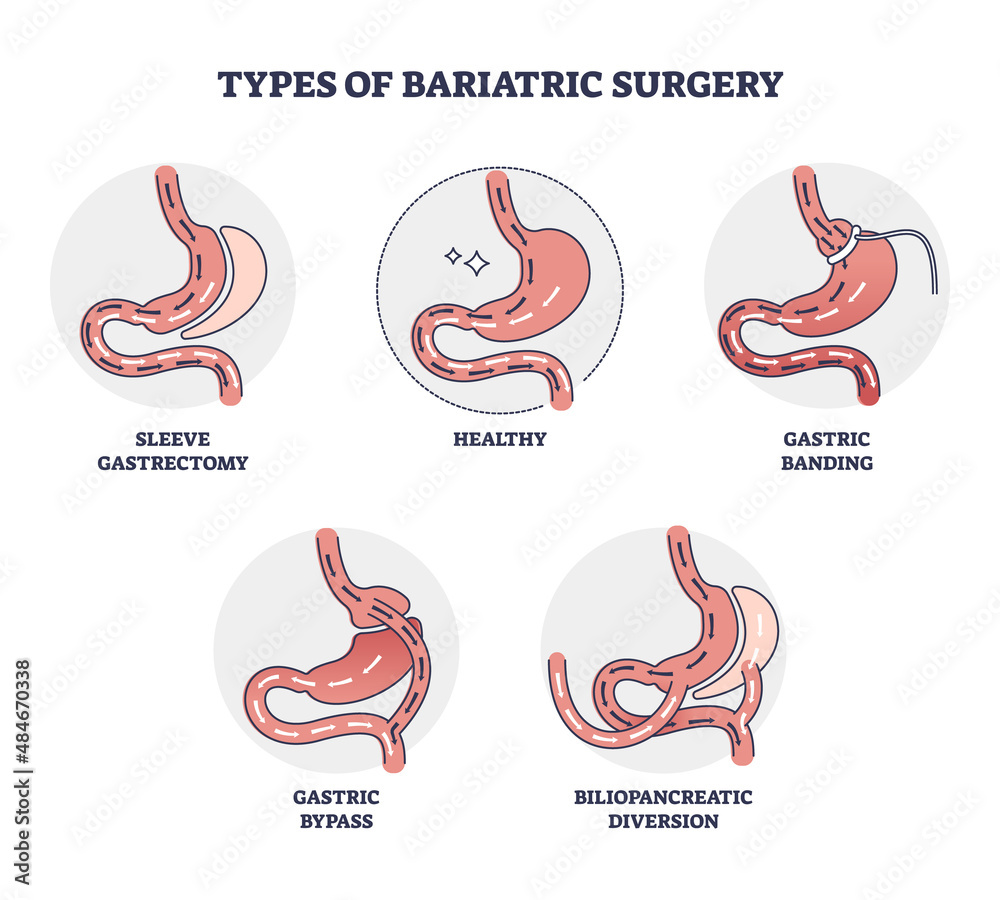 Types of bariatric surgery and stomach reduction control outline ...