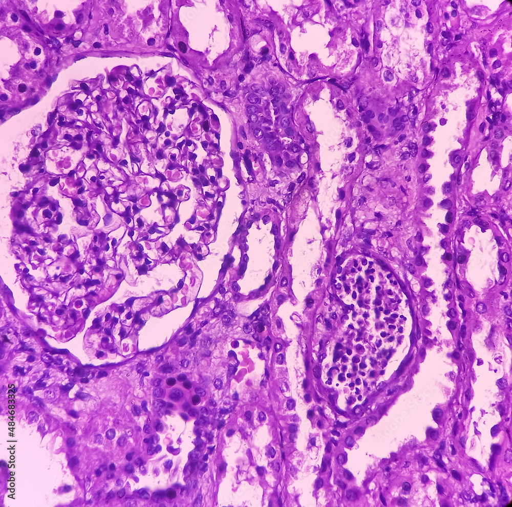 Kidney cancer: Show malignant neoplasm, clear cell carcinoma, fuhrman ...
