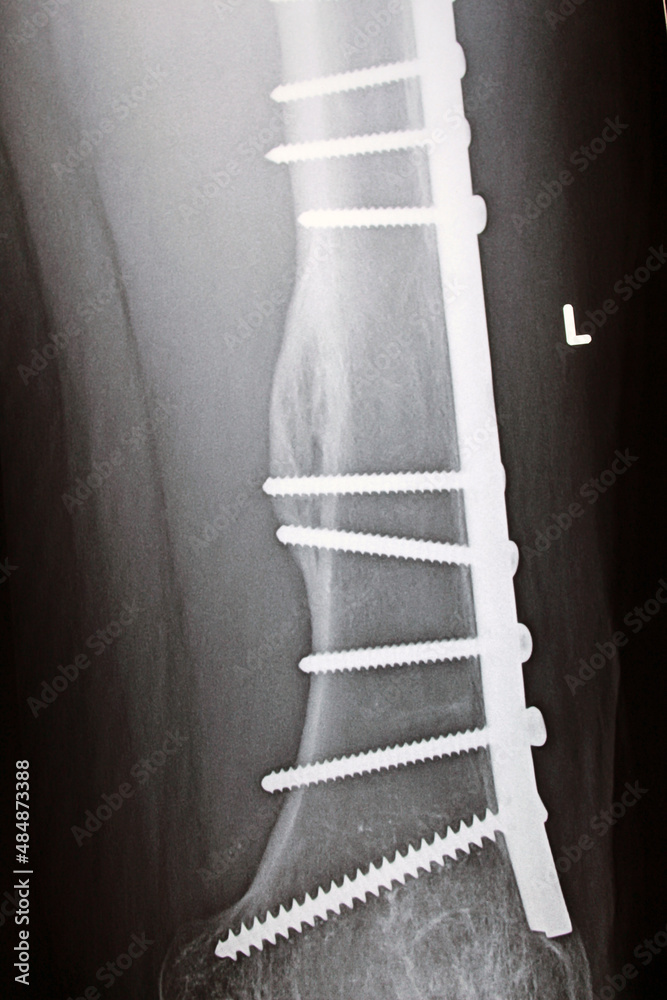 Plain X ray on the left femur that shows united mid shaft left femur ...