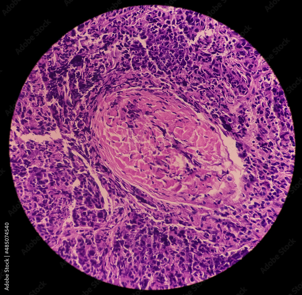 Nasopharyngeal carcinoma, nasopharynx cancer, microscopic show ...