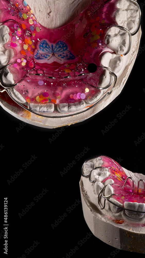 Dental plate. Expansion of the jaw in a child. Color Orthodontic plate ...