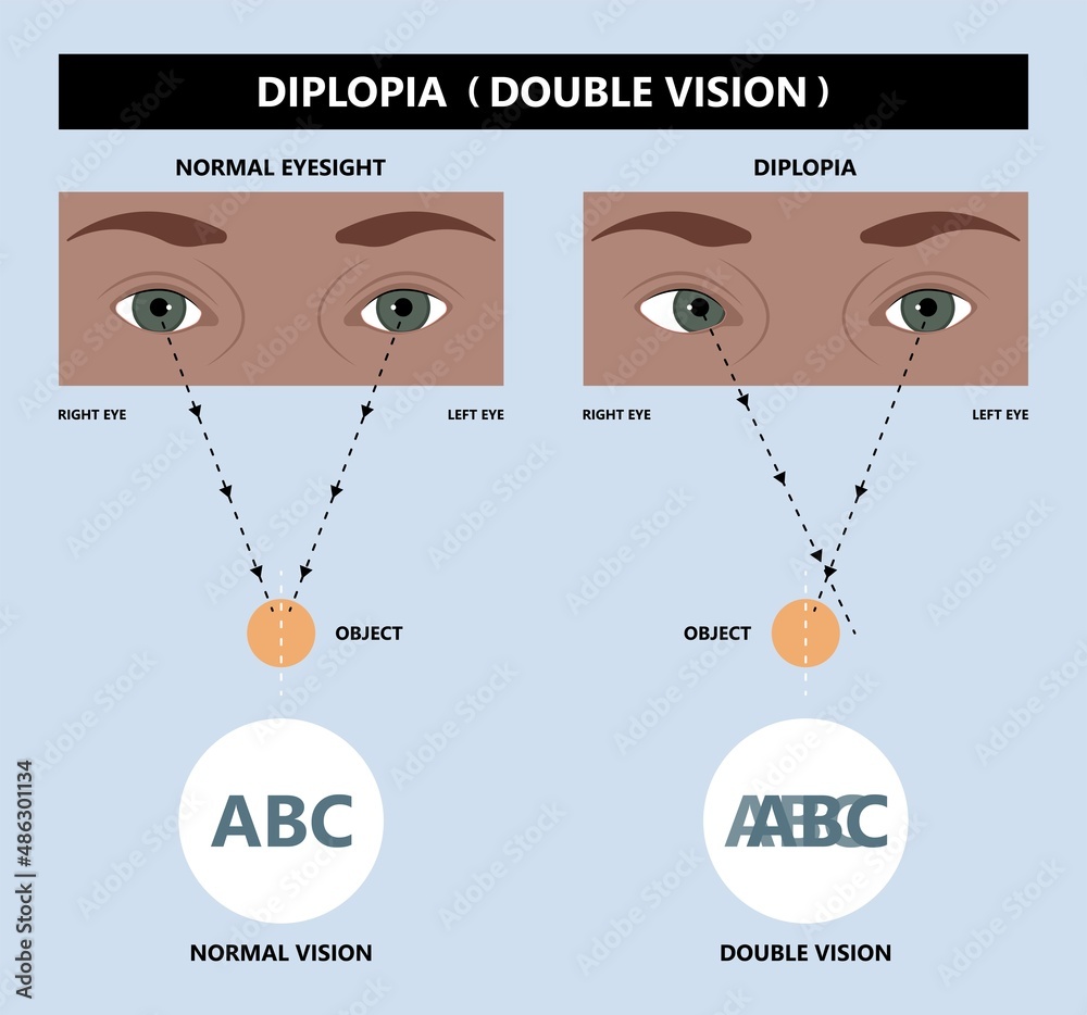 Diplopia double vision test exam brain nerve dry eye palsy gravis ...